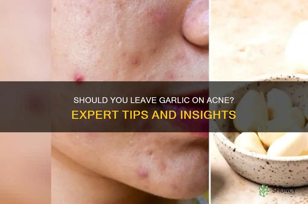 Should You Leave Garlic On Acne? Expert Tips And Insights | ShunCy