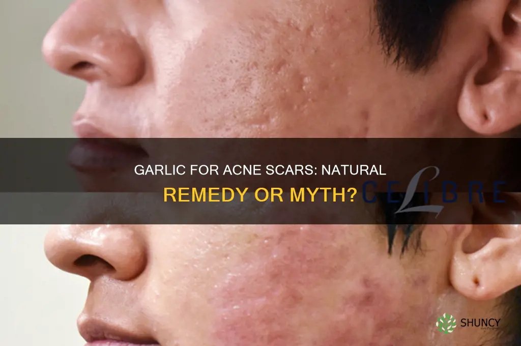 Garlic For Acne Scars: Natural Remedy Or Myth? | ShunCy
