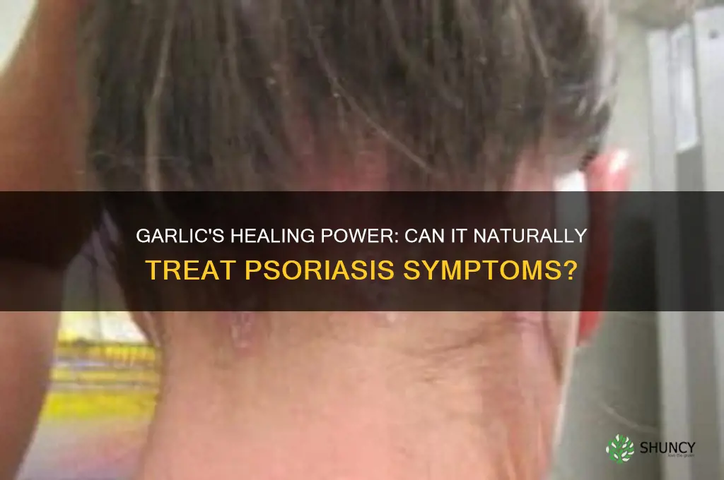 Garlic's Healing Power: Can It Naturally Treat Psoriasis Symptoms? | ShunCy