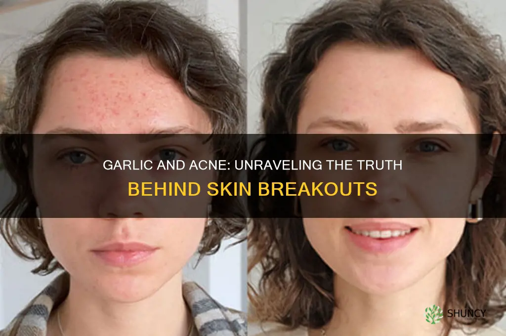 Garlic And Acne: Unraveling The Truth Behind Skin Breakouts | ShunCy