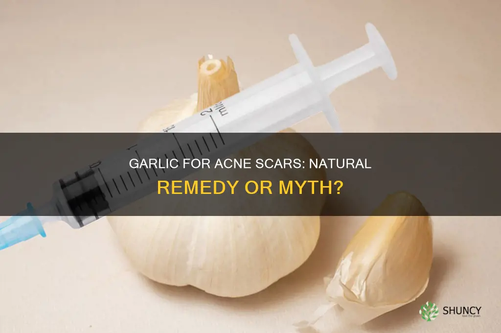 Garlic For Acne Scars: Natural Remedy Or Myth? | ShunCy